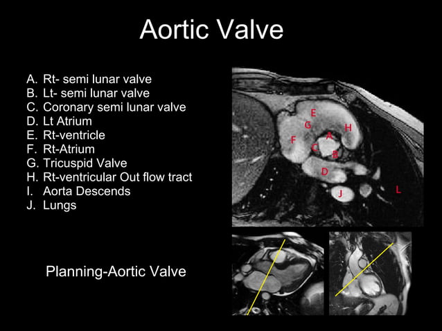 Cardiac mri&slice anatomy | PPT | Heart and Cardiovascular Diseases ...