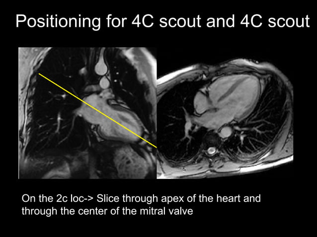 Cardiac mri&slice anatomy | PPT | Heart and Cardiovascular Diseases ...