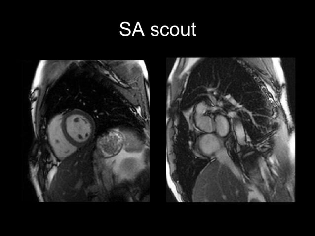 Cardiac mri&slice anatomy | PPT | Heart and Cardiovascular Diseases ...