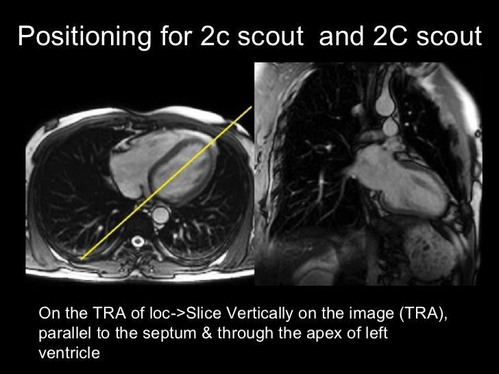 Mri Cardiac Anatomy