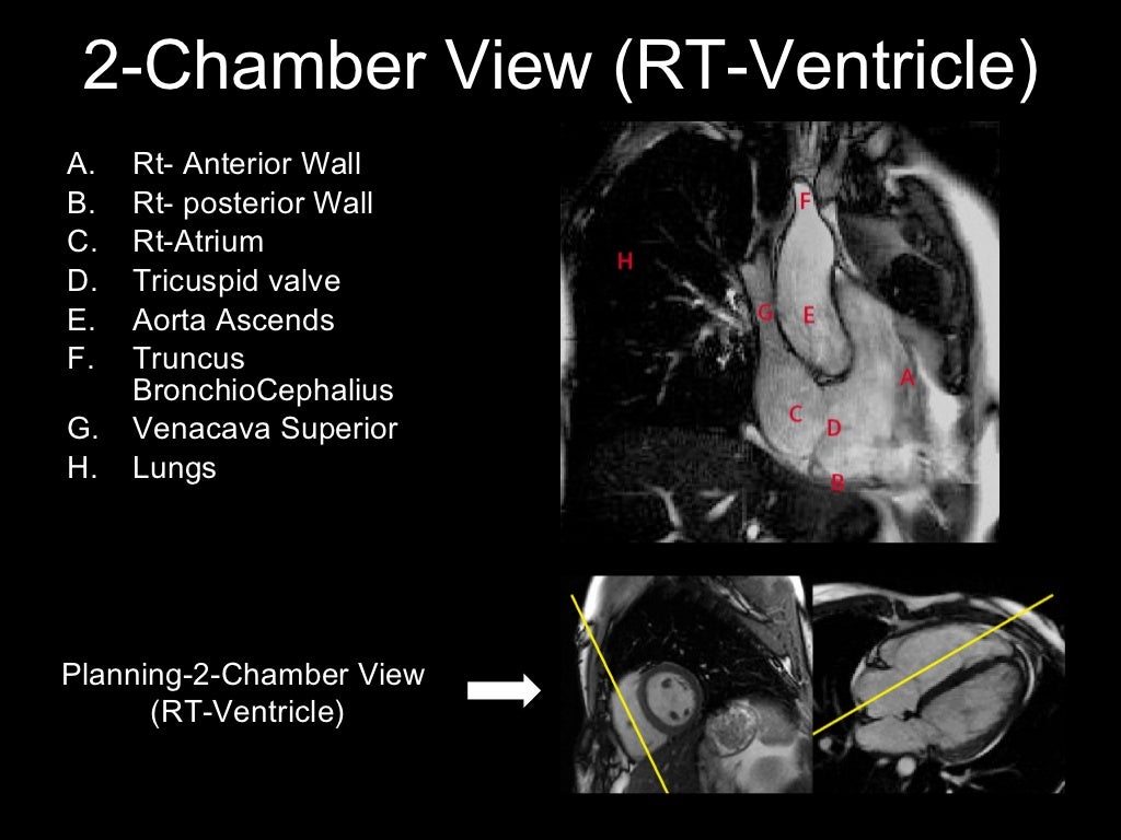 Cardiac Mriandslice Anatomy