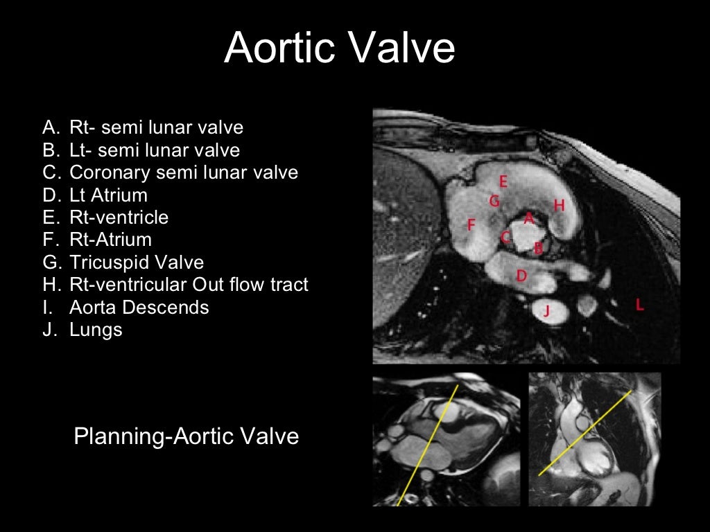 Mri Cardiac Anatomy