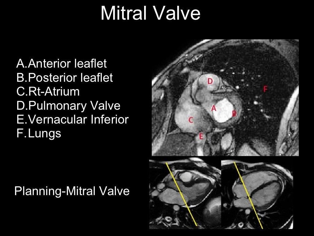 Mri Cardiac Anatomy