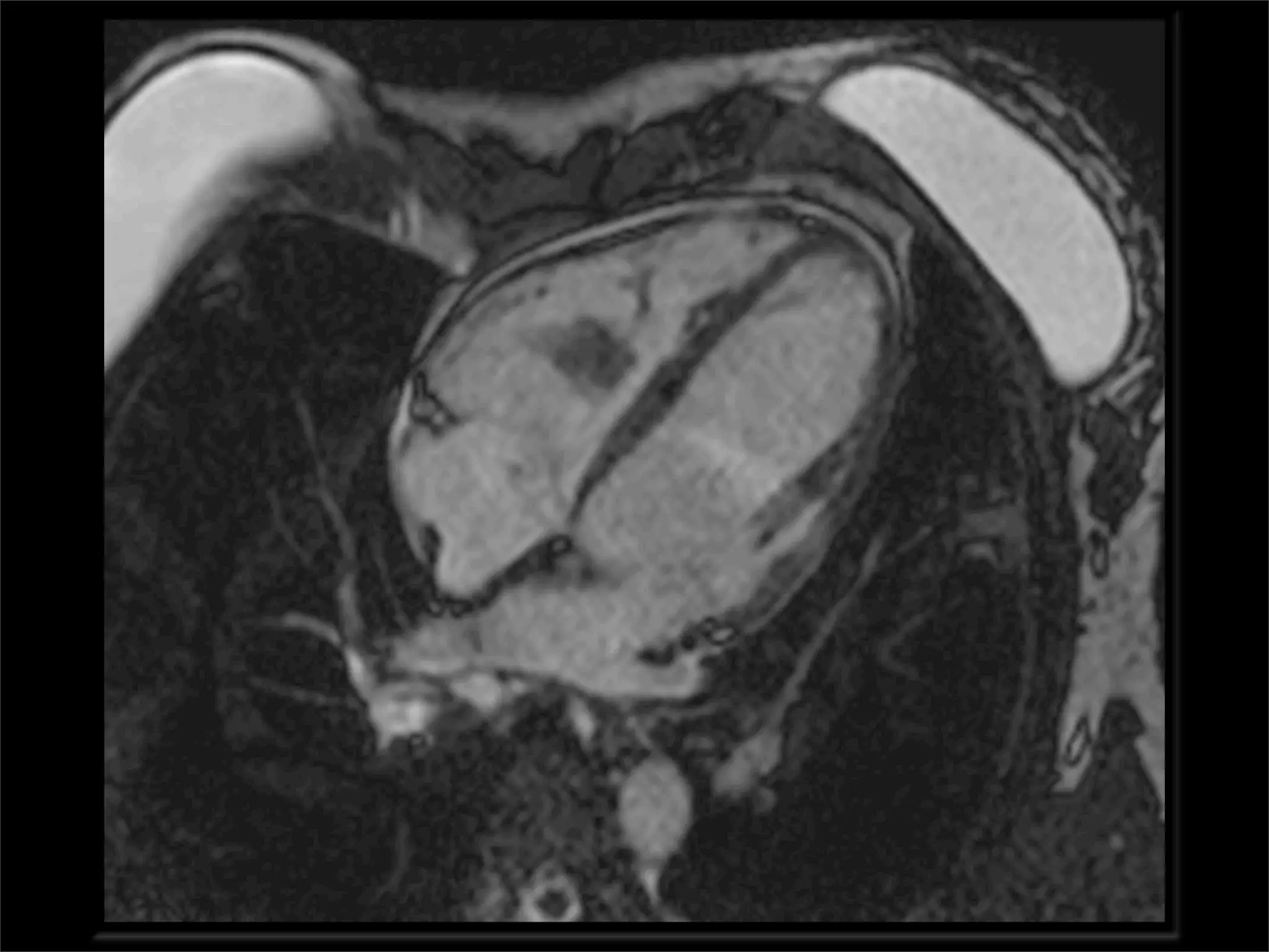 Cardiac mr sequences | PDF
