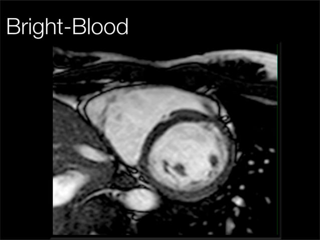 Cardiac mr sequences | PPT
