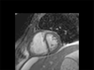 Cardiac mr sequences | PDF