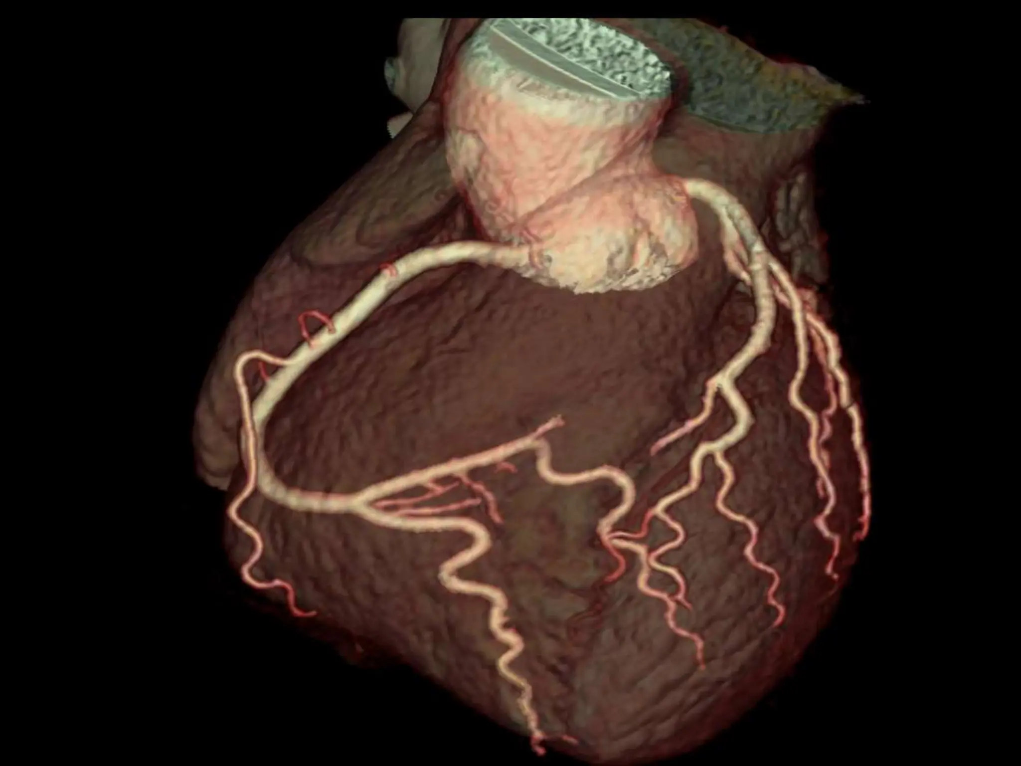 cardiac multislice CT.prospective ECG ,retrospective ECG Gating.pptx