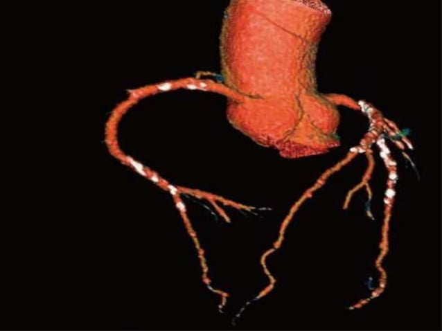 cardiac multislice CT.prospective ECG ,retrospective ECG Gating.pptx