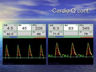Cardiac output monitoring | PPT