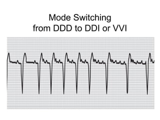 Cardiac pacemakers part ii | PPT