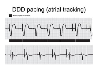 Cardiac pacemakers part ii | PPT