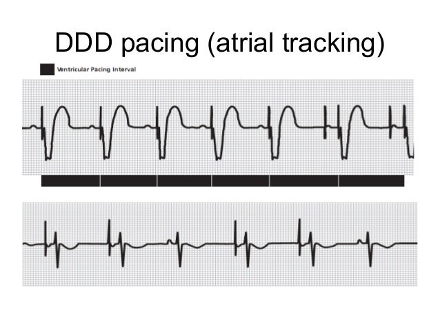 Cardiac pacemakers part ii