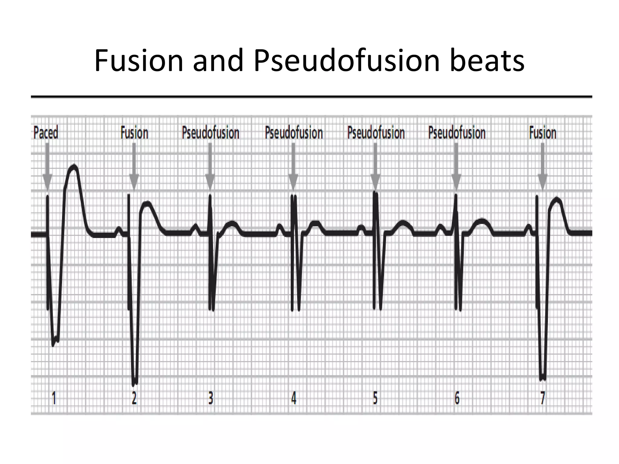 Cardiac pacemakerspart iii | PPT