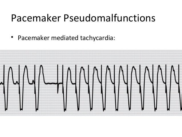 Cardiac pacemakerspart iii