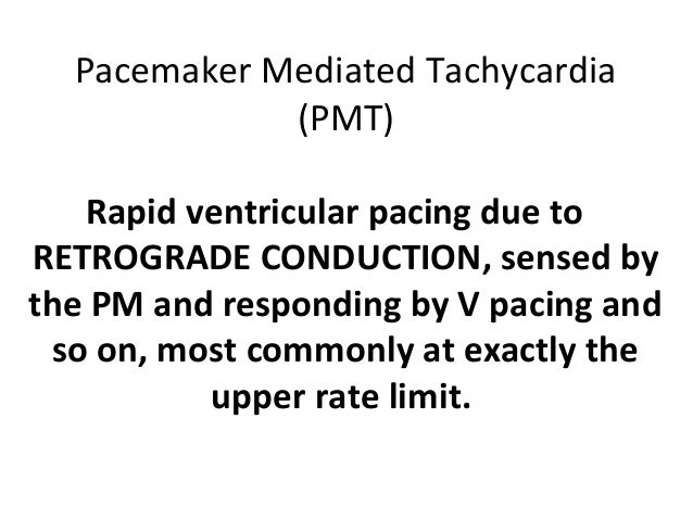 Tachycardia Pacemaker Mediated Figure Ventricular Ecg Rhythm Pacing ...