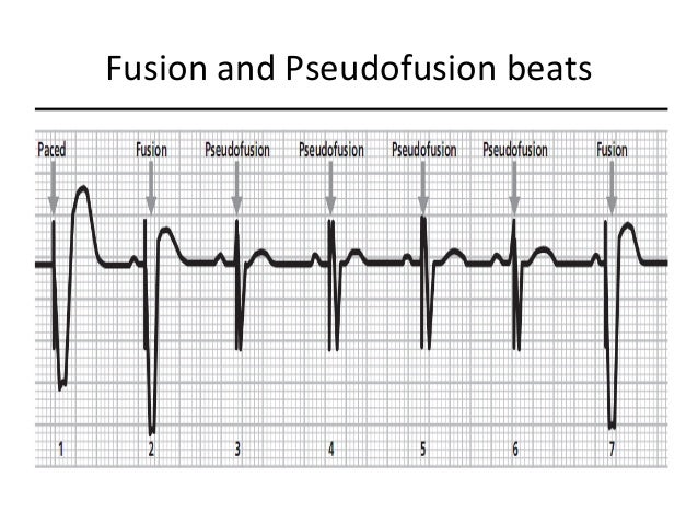 Cardiac pacemakerspart iii