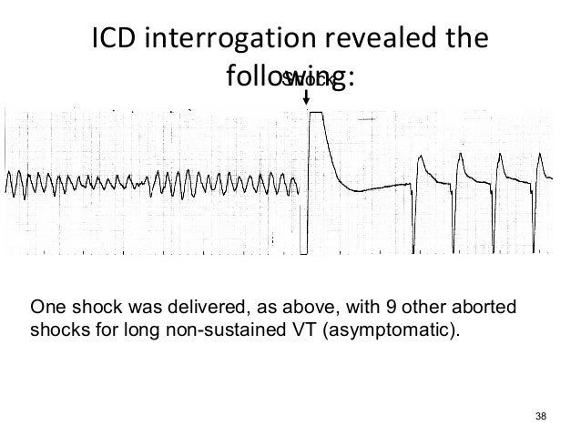Cardiac pacemakerspart iii