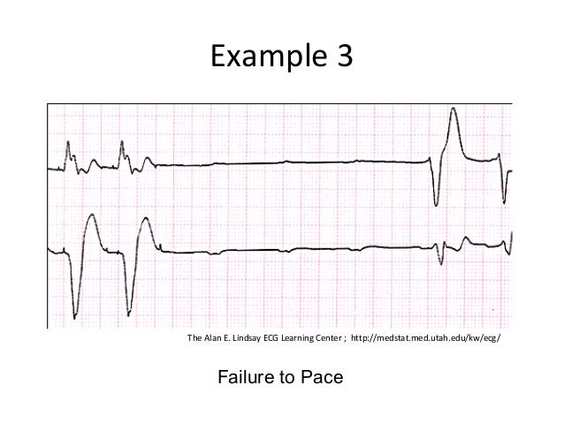 Cardiac pacemakerspart iii