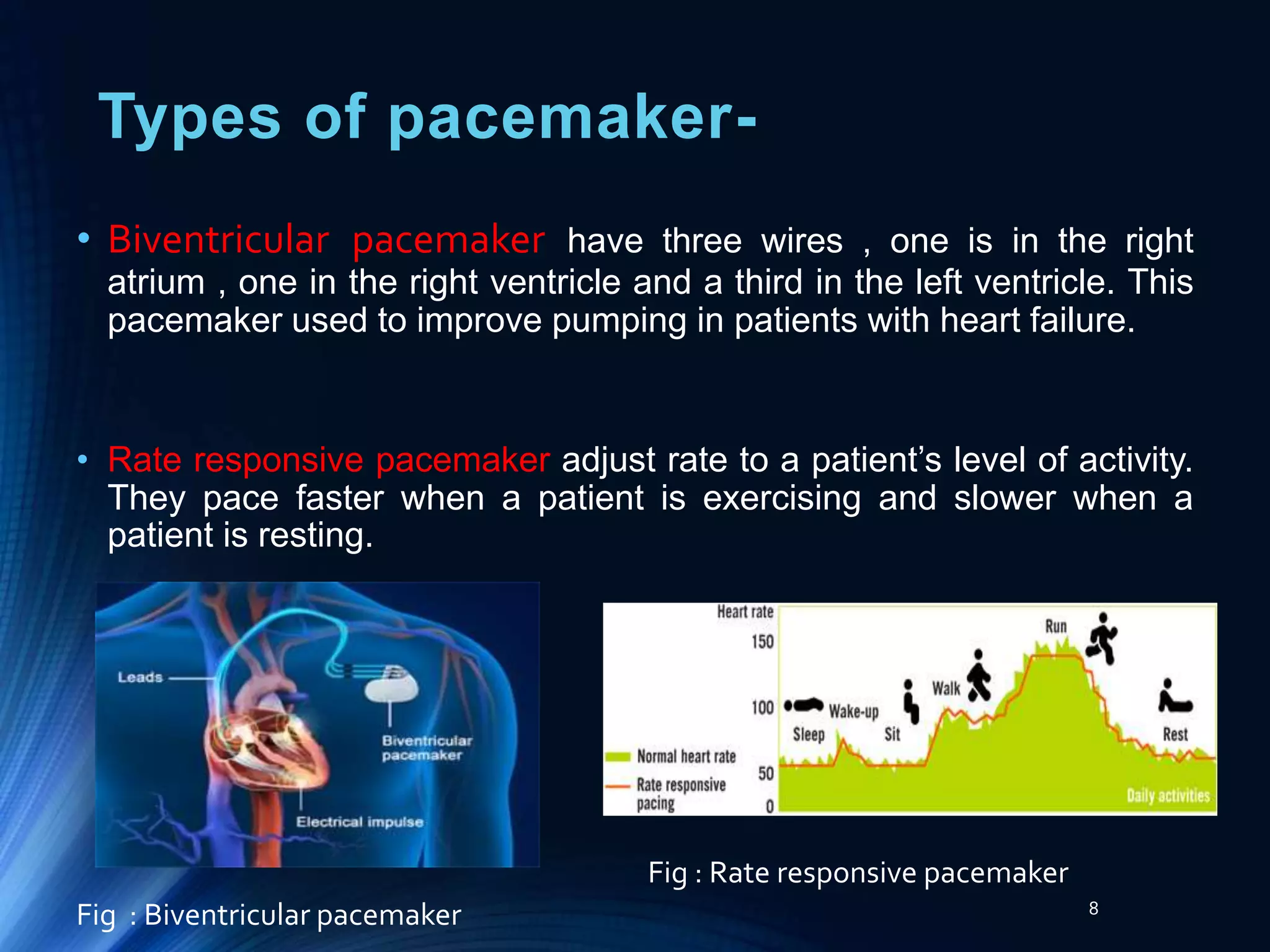 Cardiac pacemaker | PPTX