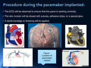 Cardiac pacemaker | PPTX