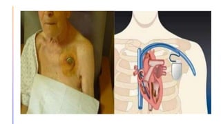 Artificial Cardiac pacemaker |medical device that generates electrical ...
