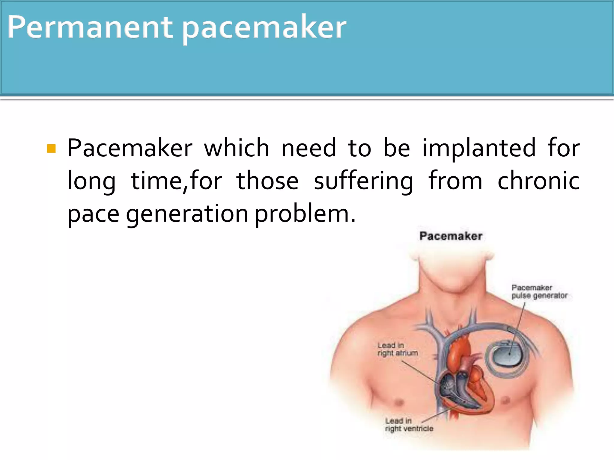 Cardiac pacemaker | PDF