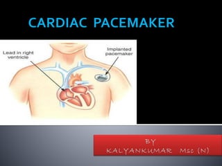 Cardiac pacemaker | PDF