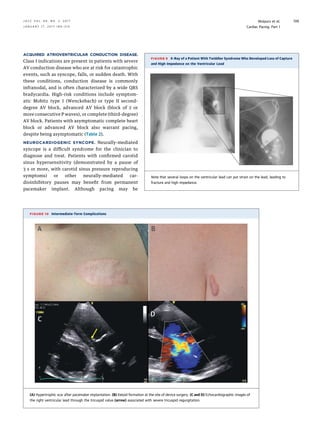 Cardiac pacemakers part-I | PDF