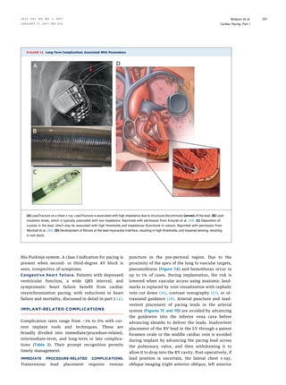 Cardiac pacemakers part-I | PDF