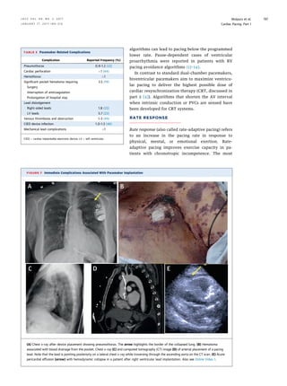 Cardiac pacemakers part-I | PDF