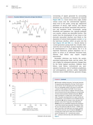 Cardiac pacemakers part-II | PDF