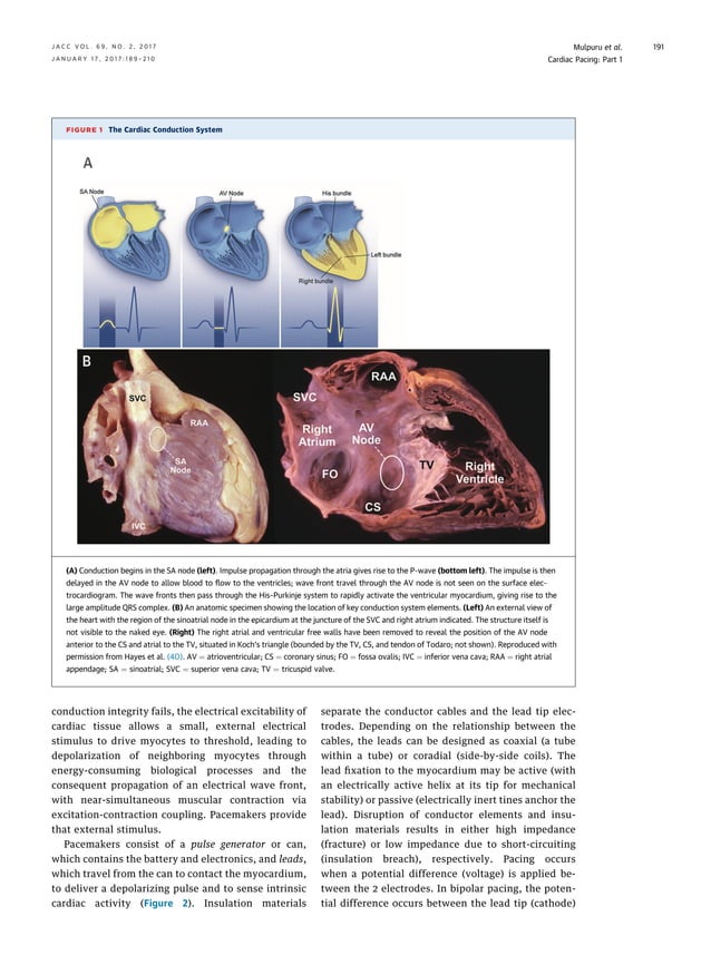 Cardiac pacemakers part-II | PDF