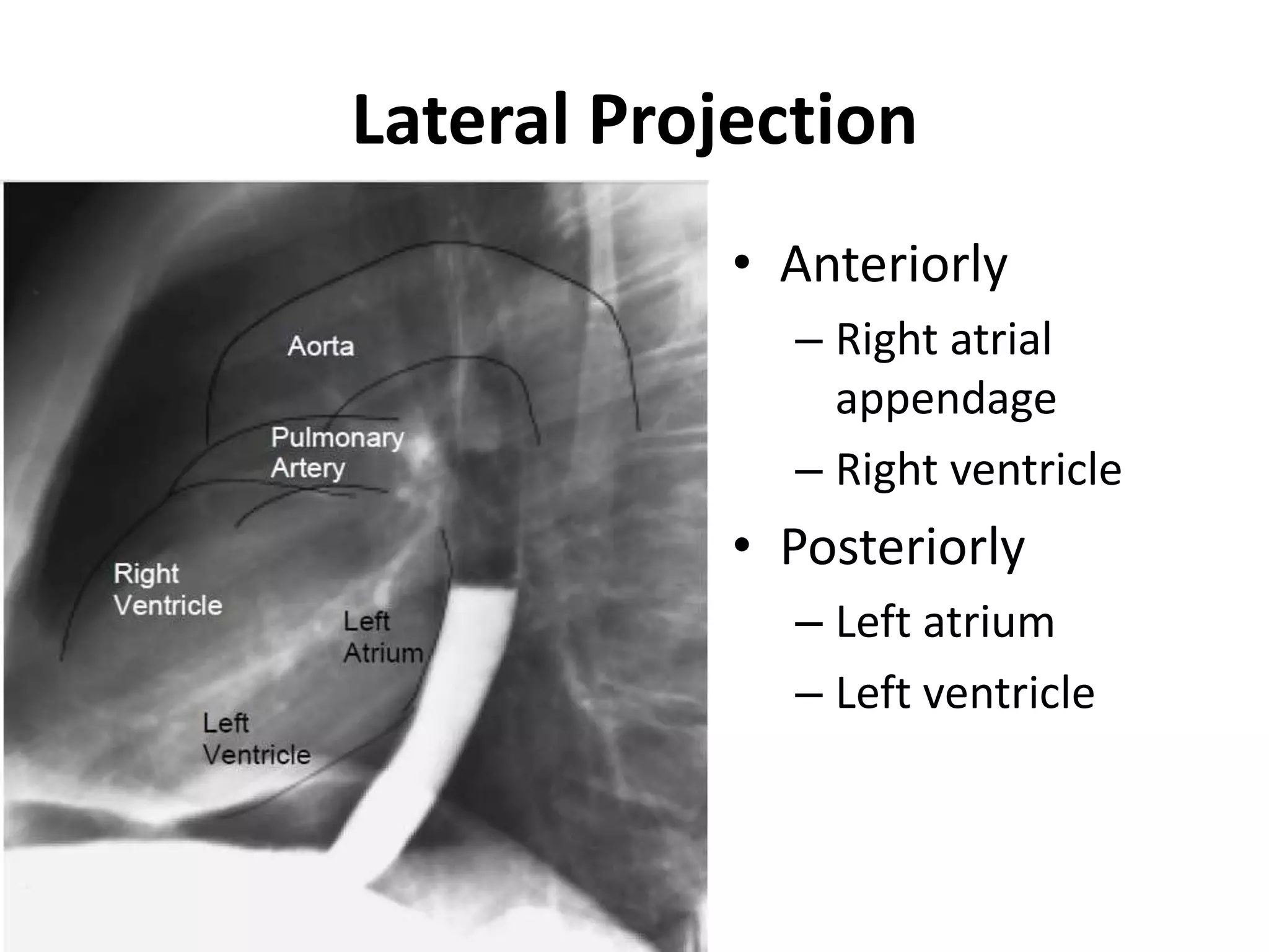 Radiographic approach to cardiac enlargement | PPTX