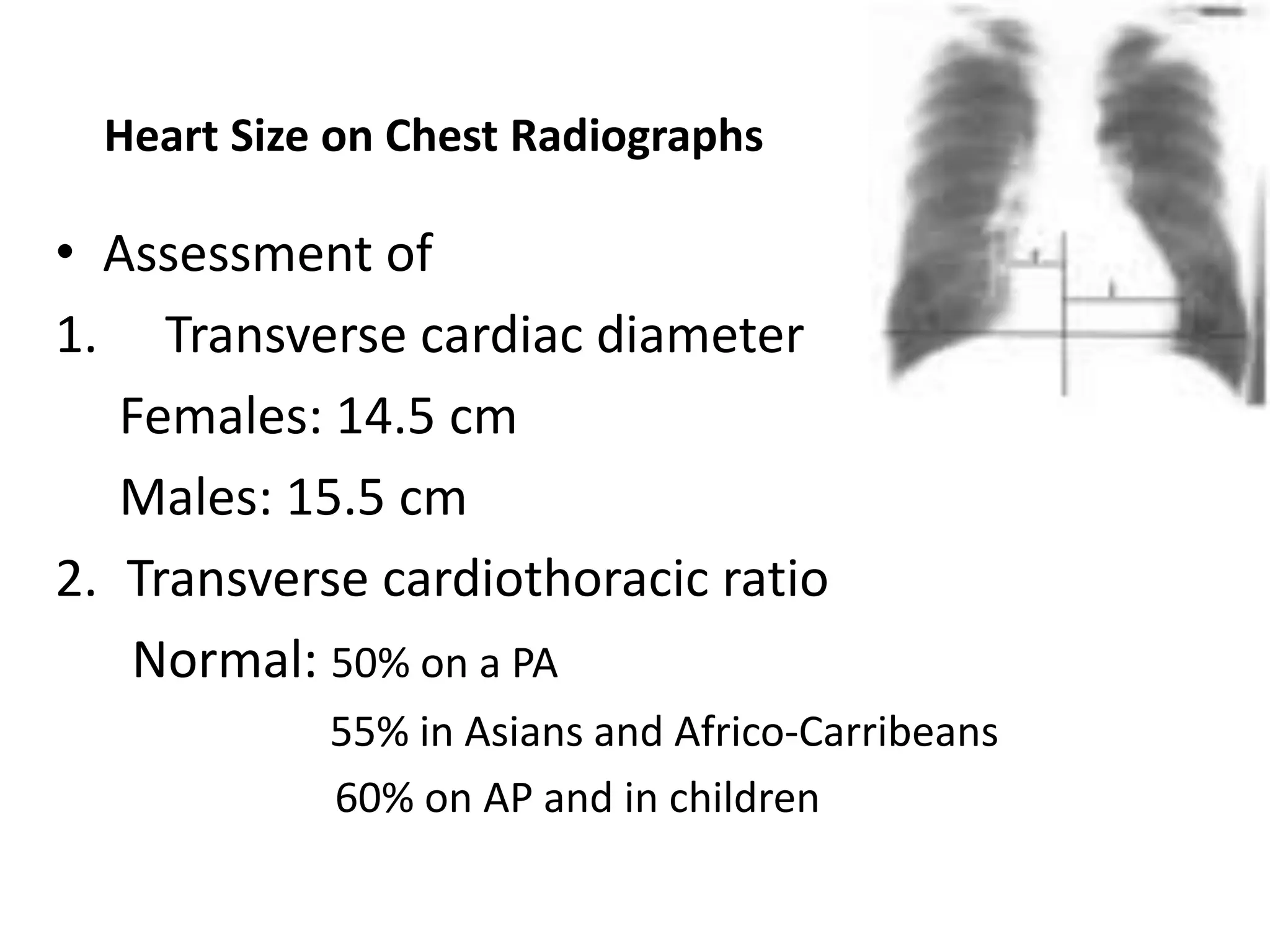 Radiographic approach to cardiac enlargement | PPTX