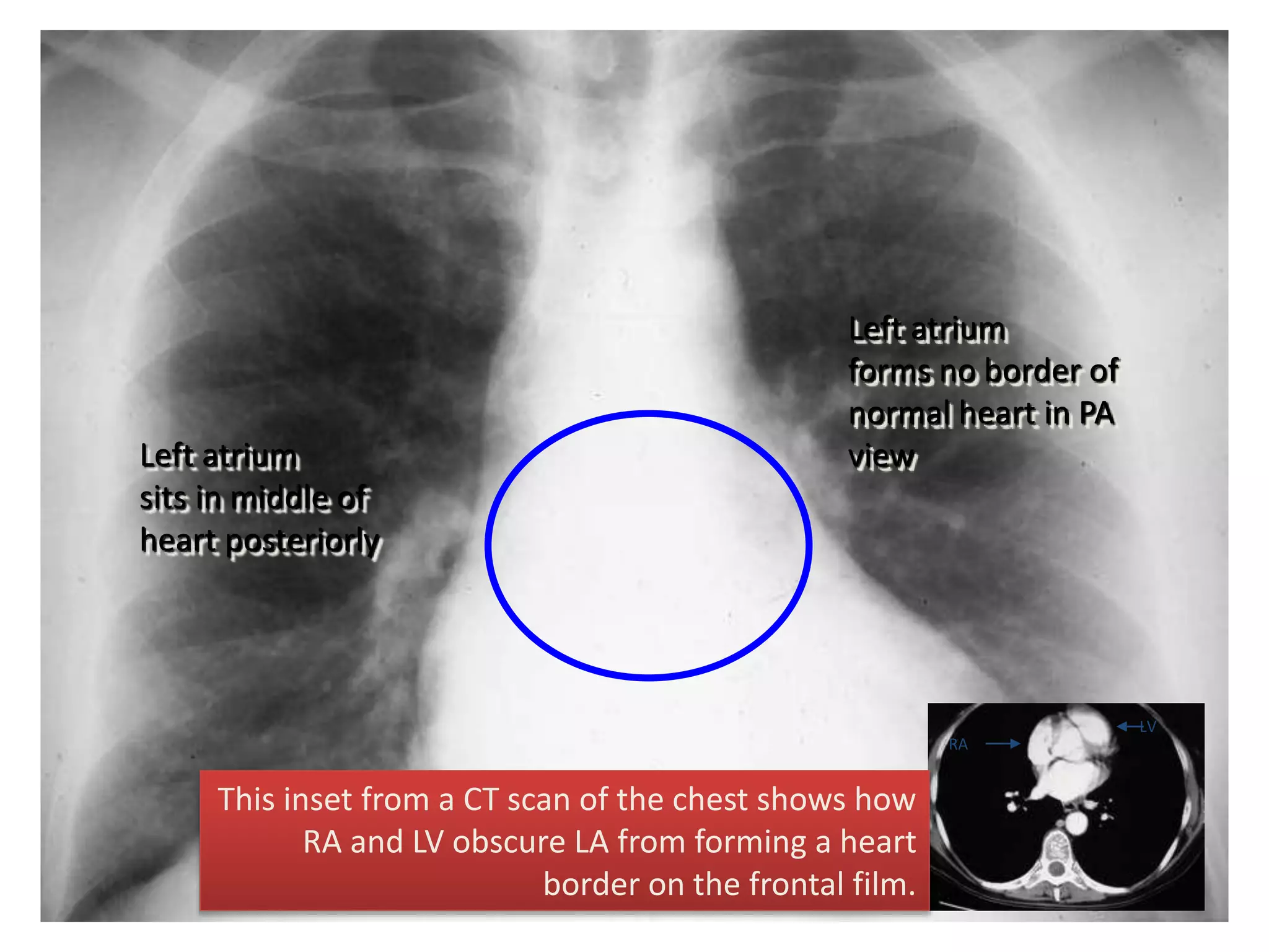 Radiographic approach to cardiac enlargement | PPTX