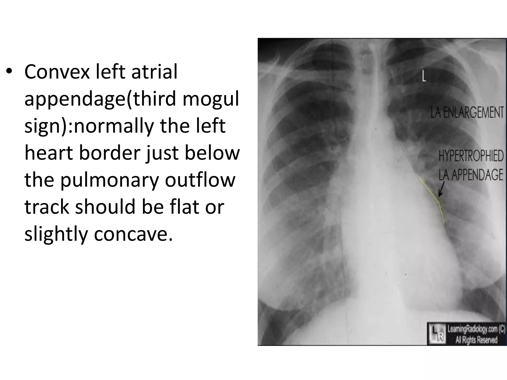 Radiographic approach to cardiac enlargement | PPTX