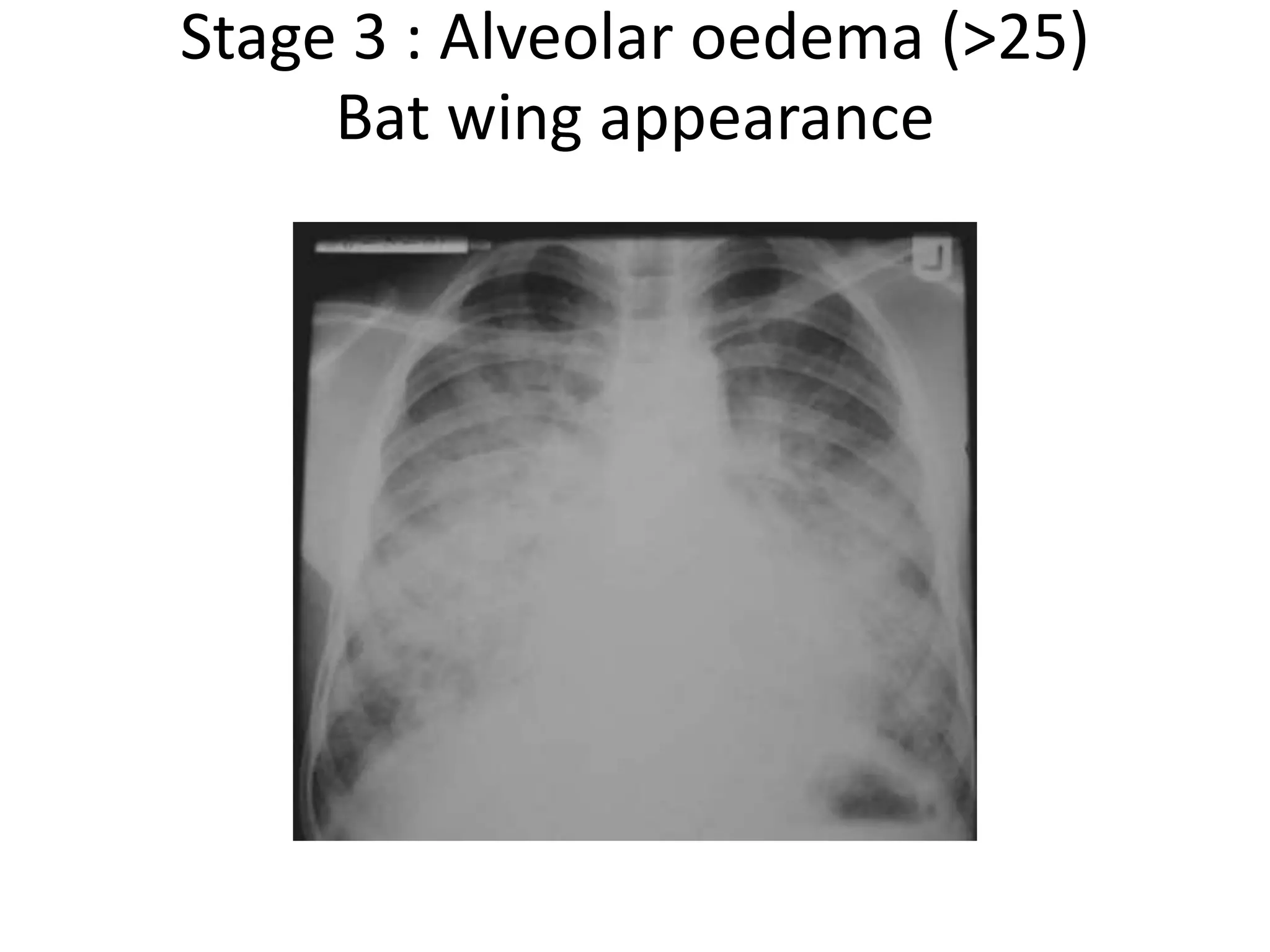 Radiographic approach to cardiac enlargement | PPTX