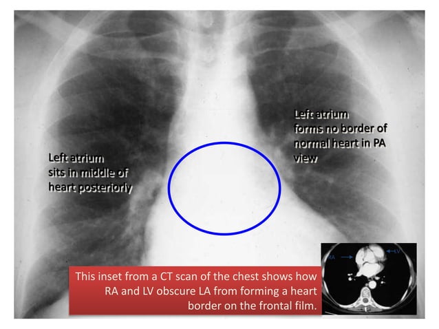 Radiographic approach to cardiac enlargement | PPTX | Heart and ...