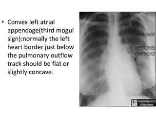 Radiographic approach to cardiac enlargement | PPTX