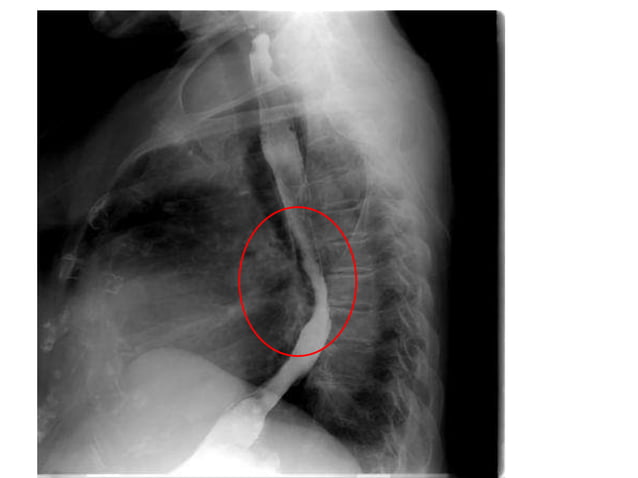 Radiographic approach to cardiac enlargement | PPTX | Heart and ...