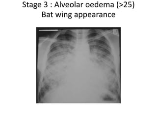 Radiographic approach to cardiac enlargement | PPTX
