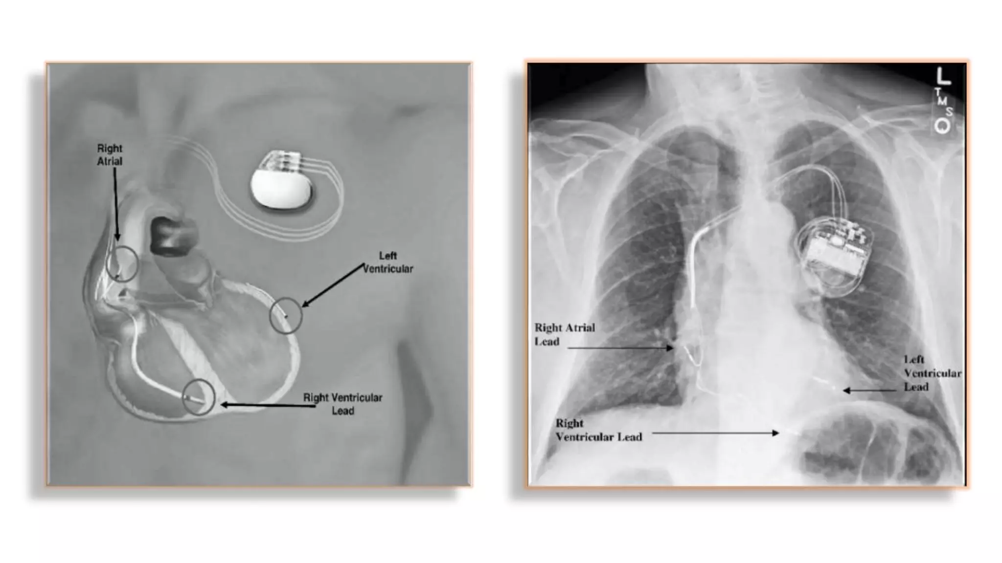 Cardiac Resynchronisation therapy.pptx