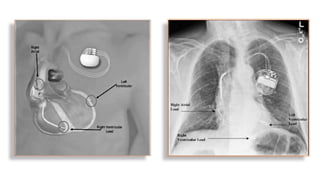 Cardiac Resynchronisation therapy.pptx
