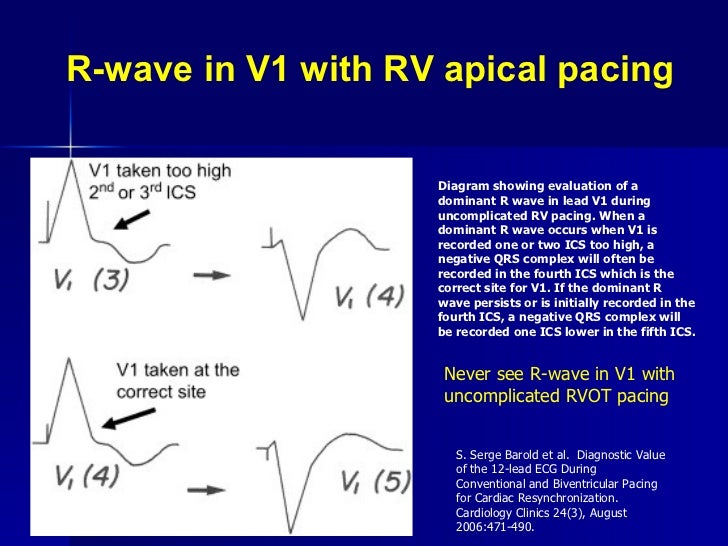 Cardiac resynchronization