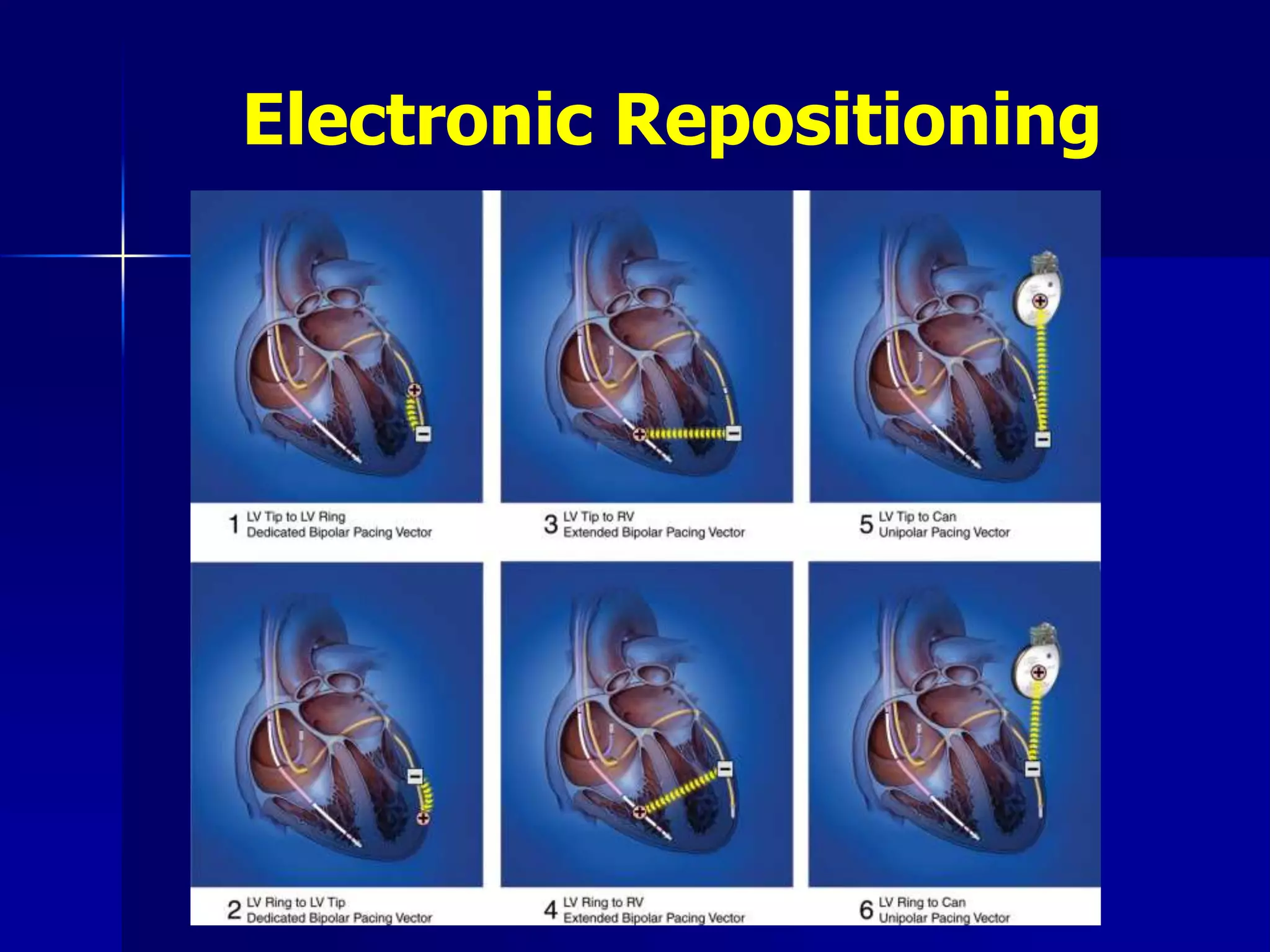 Cardiac resynchronization | PPT