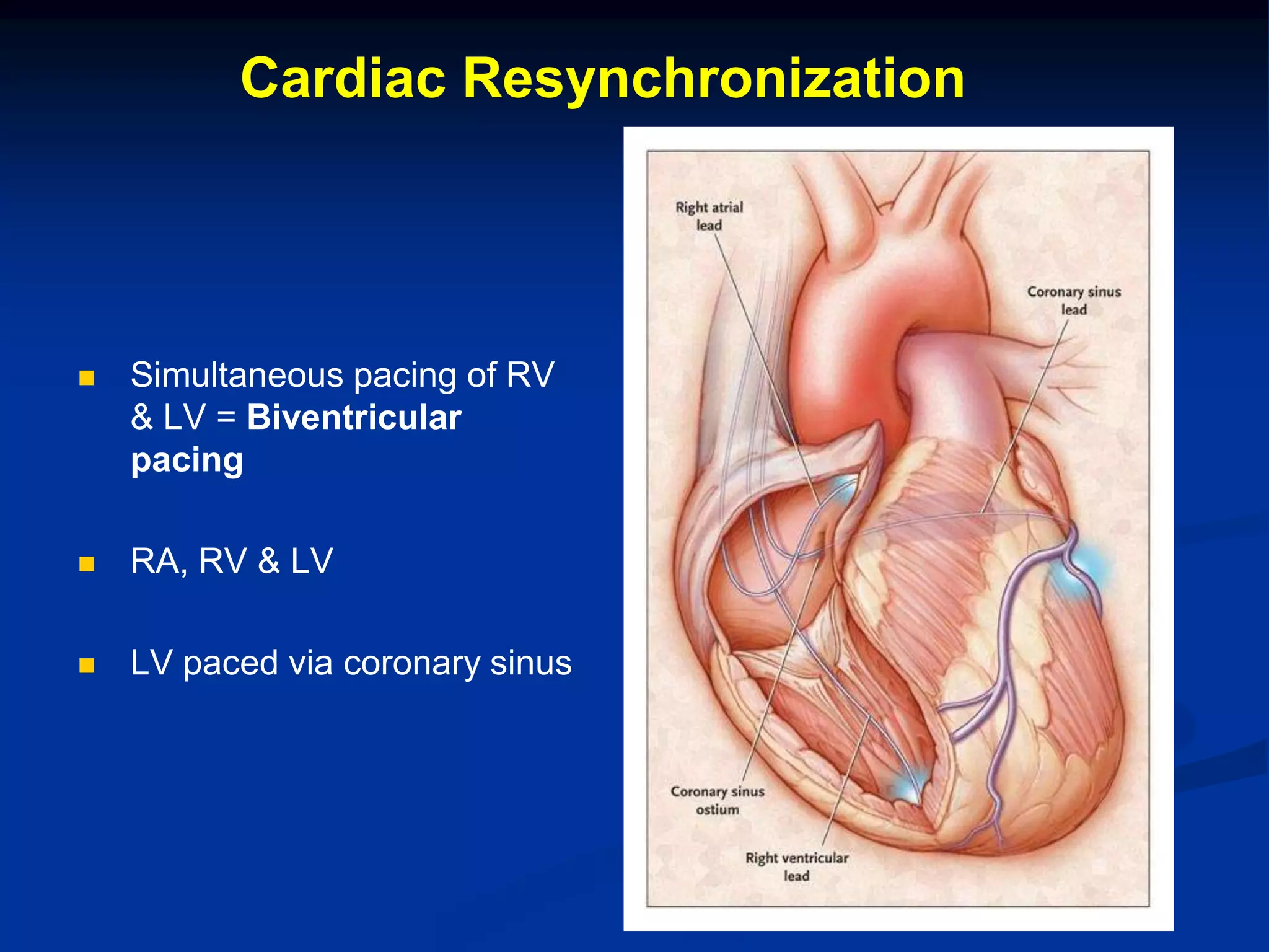 Cardiac resynchronization | PPT