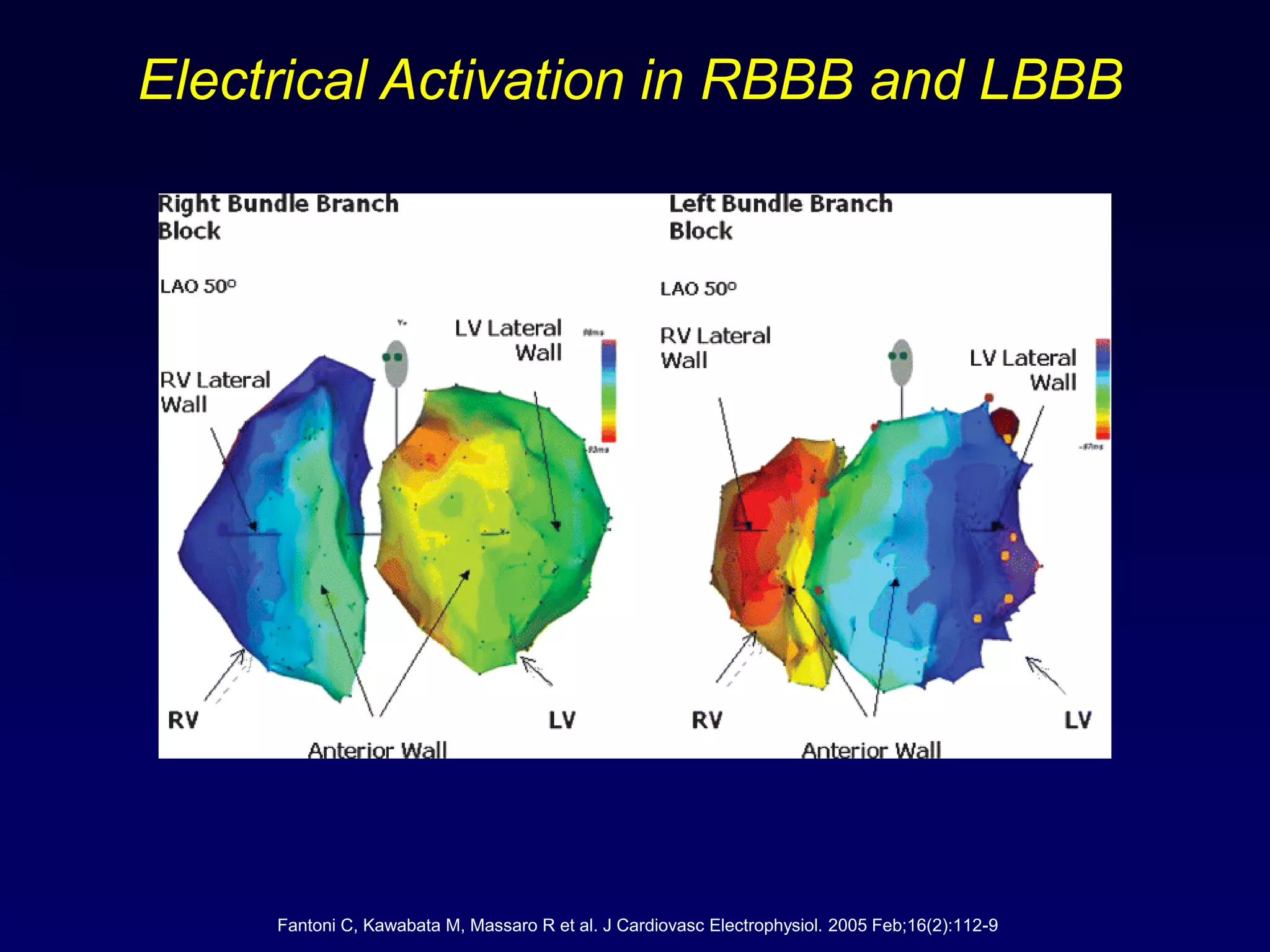 Cardiac resynchronization therapy : Atrial Fibrillation | PDF