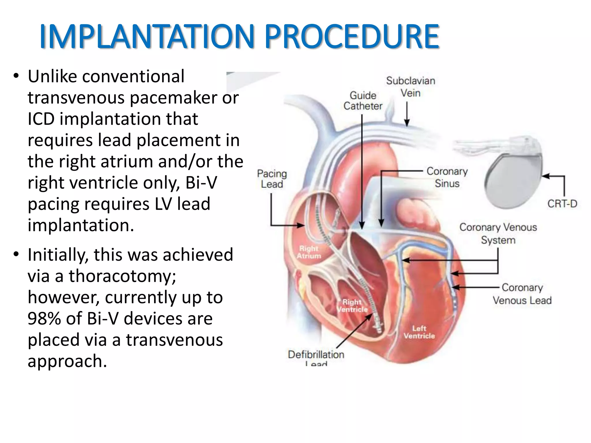 Cardiac resynchronization therapy | PPTX