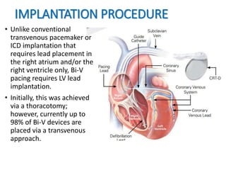 Cardiac resynchronization therapy | PPTX