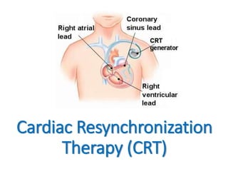 Cardiac resynchronization therapy | PPTX